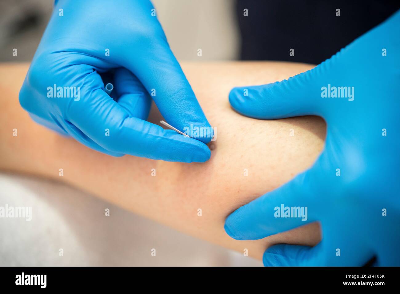 Close-up of a needle and hands of physiotherapist doing a dry needling ...