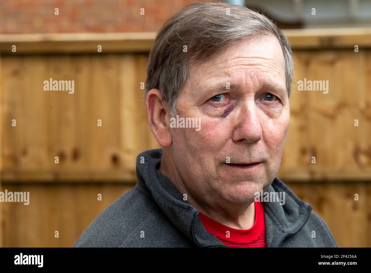 Mature man with a black eye shiner Stock Photo - Alamy