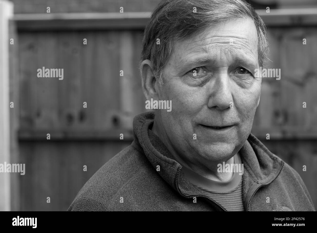 Hematoma eye Black and White Stock Photos & Images - Alamy