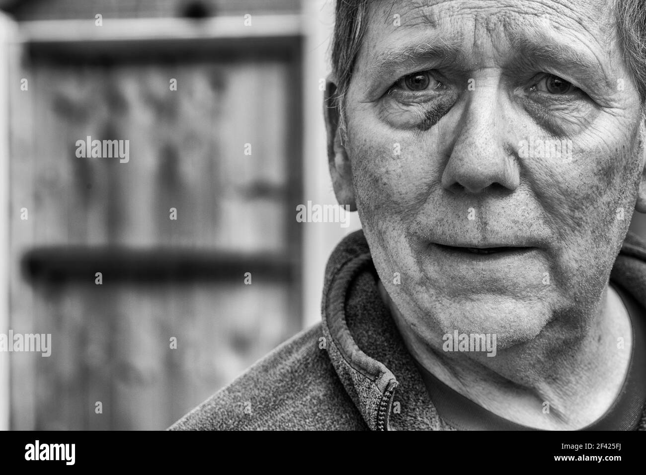 Mature man with a black eye shiner Stock Photo - Alamy