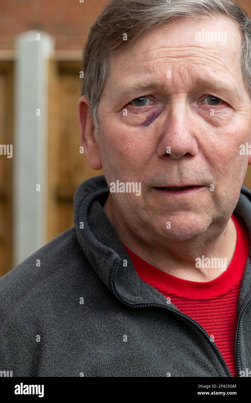 Mature man with a black eye shiner Stock Photo - Alamy