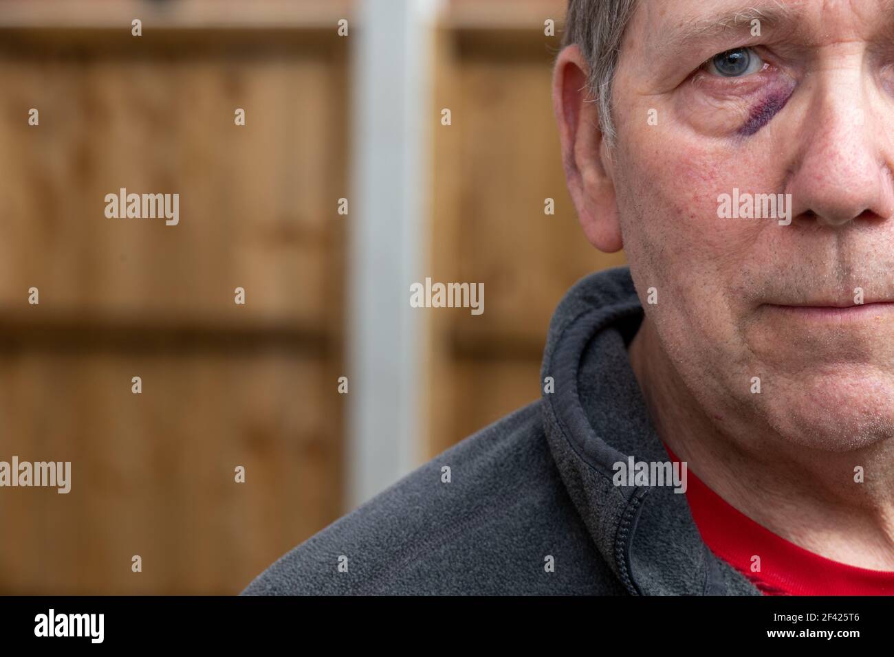 Mature man with a black eye shiner Stock Photo - Alamy