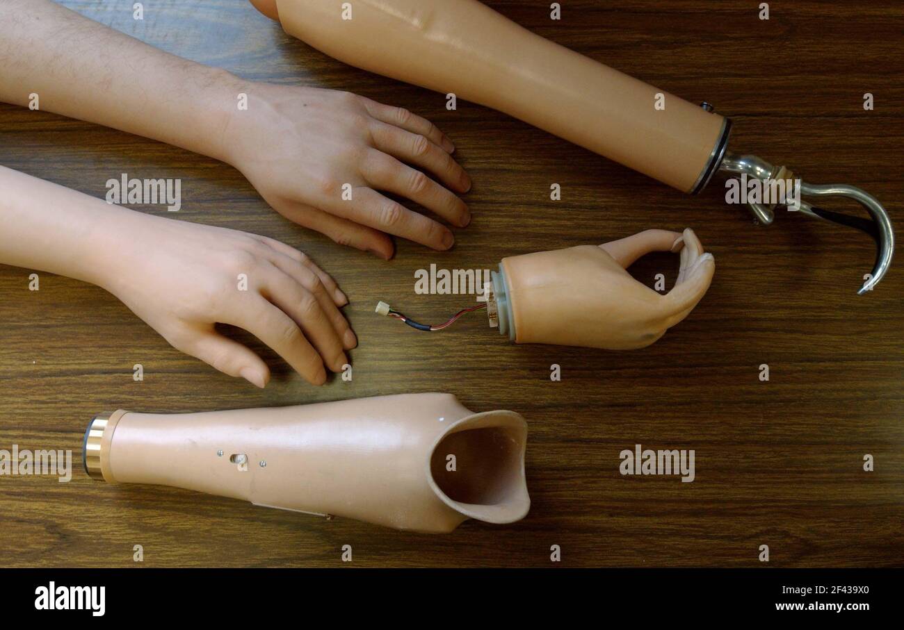 DIFFERENT TYPES OF PROTHESIS AT ST MARYS HOSPITAL,ROEHAMPTON.11/4/03 ...