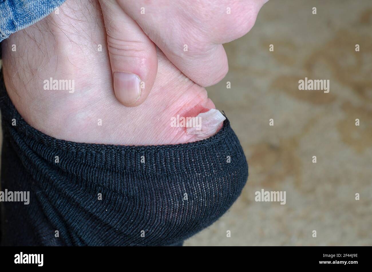 cA man's leg with a dropped black toe and a burst callus. Top view at ...