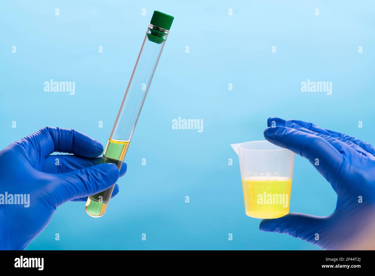 Urine analysis in the laboratory. Medical urine test. Urine sample for ...