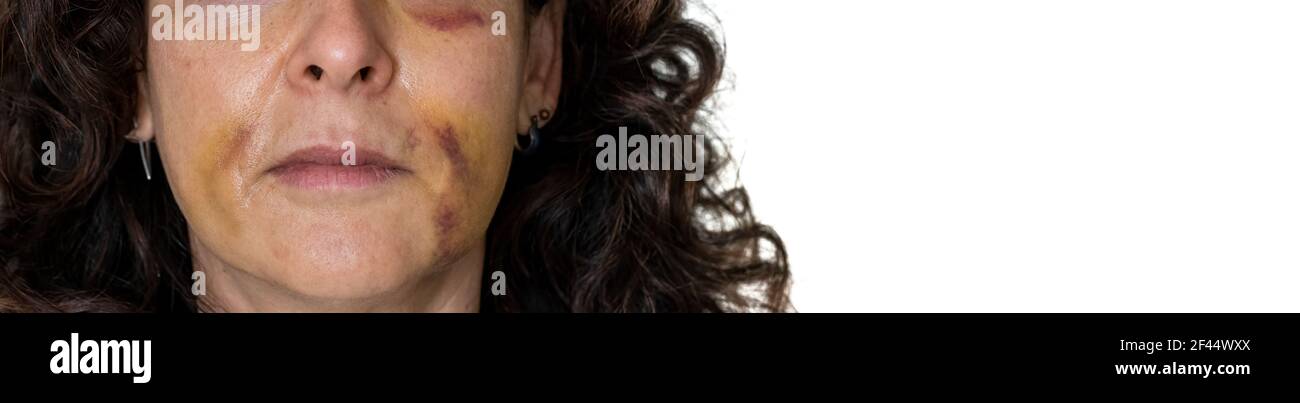 Bruises hi-res stock photography and images - Alamy