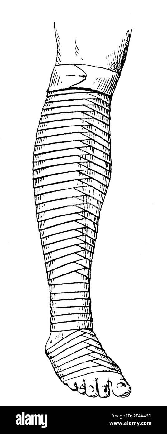 Downright bandaging the leg. Illustration of the 19th century. Germany ...