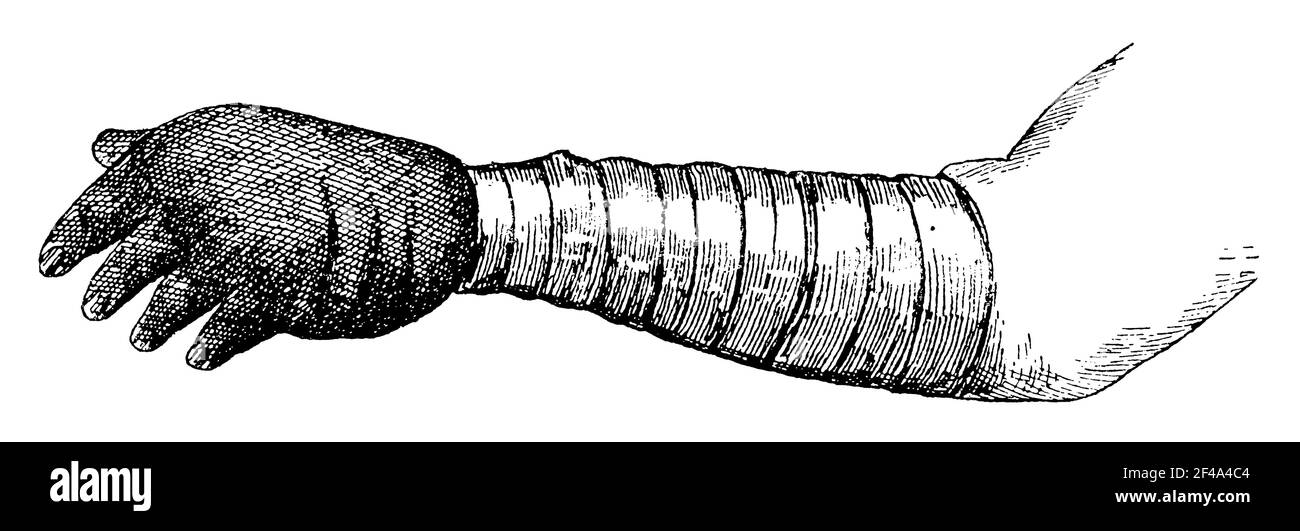 A limb that dies as a result of too tight and prolonged constriction ...