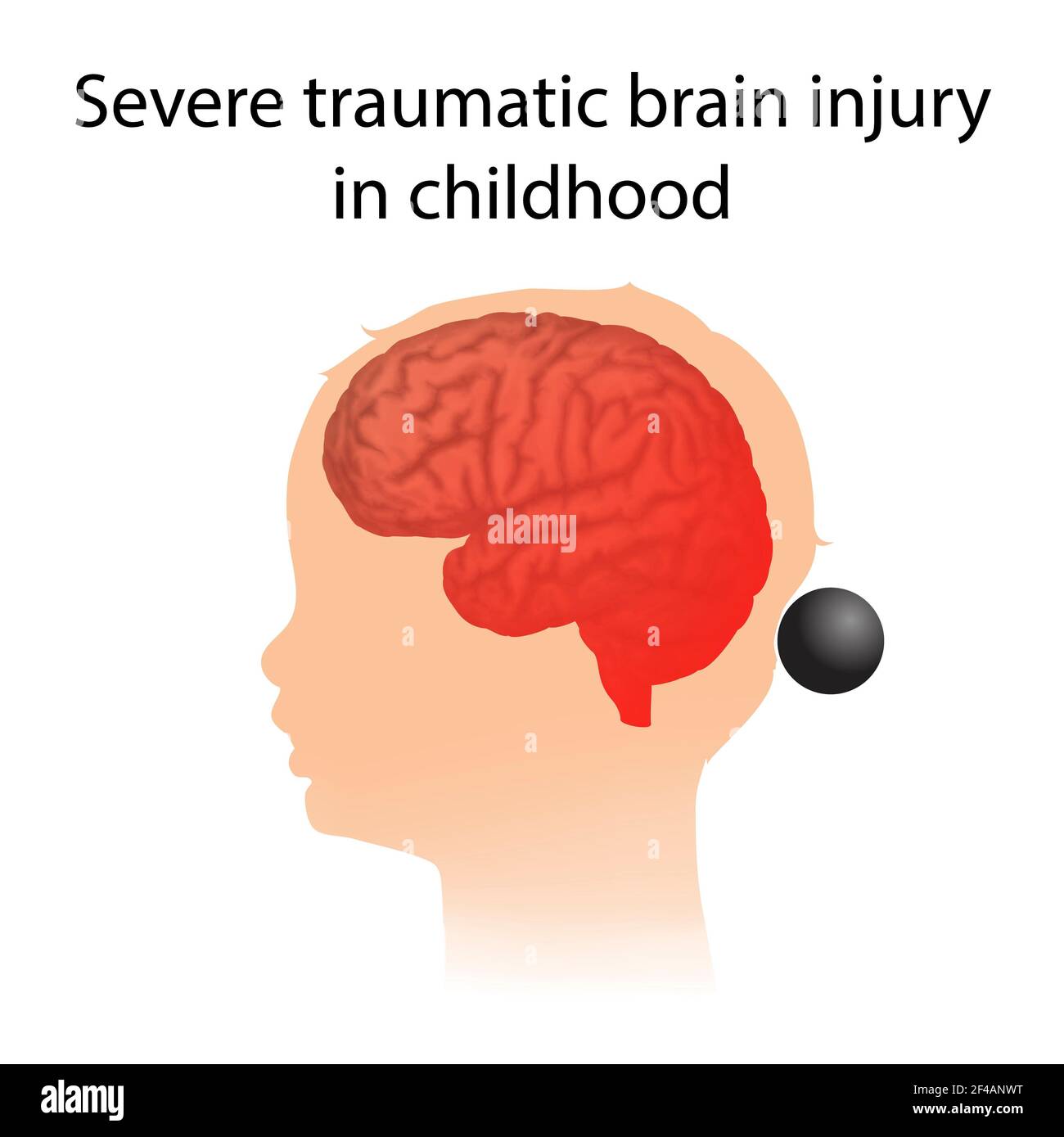Traumatic Brain Injury High Resolution Stock Photography and Images - Alamy Traumatic Brain Injury High Resolution Stock Photography and Images - Alamy