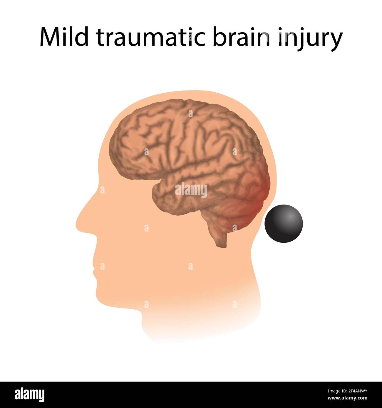 Traumatic Brain Injury High Resolution Stock Photography and Images - Alamy Traumatic Brain Injury High Resolution Stock Photography and Images - Alamy