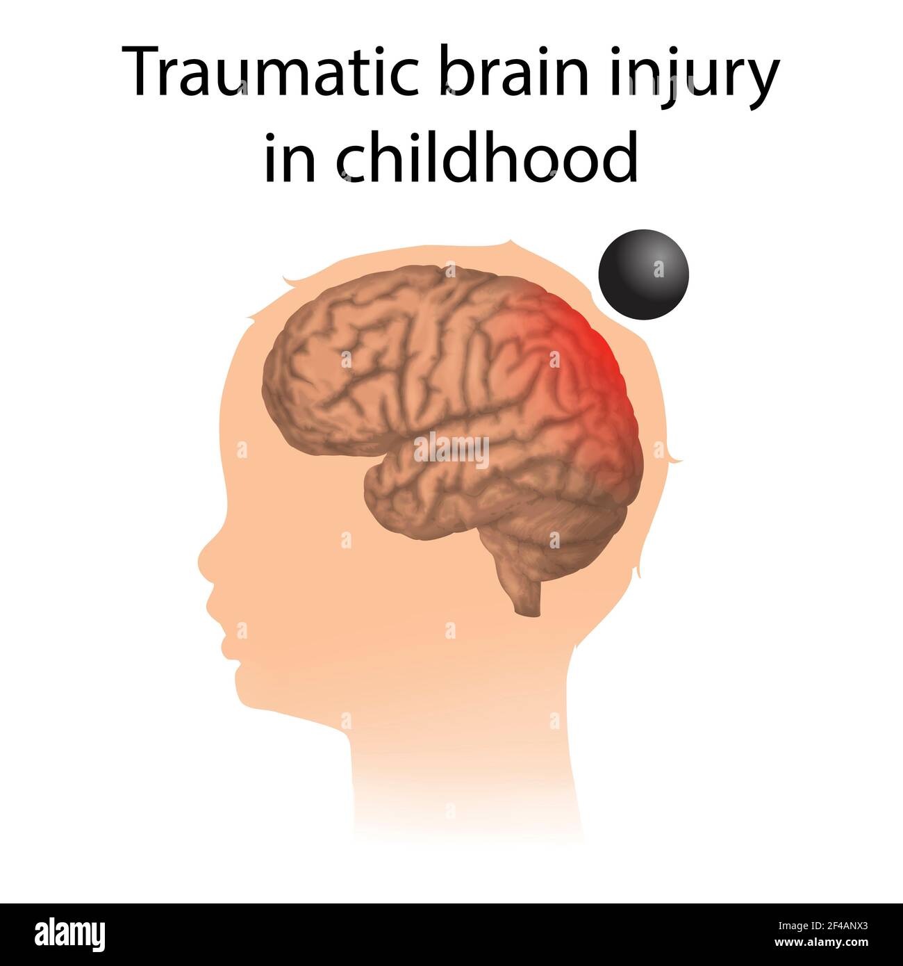 Traumatic Brain Injury High Resolution Stock Photography and Images - Alamy Traumatic Brain Injury High Resolution Stock Photography and Images - Alamy