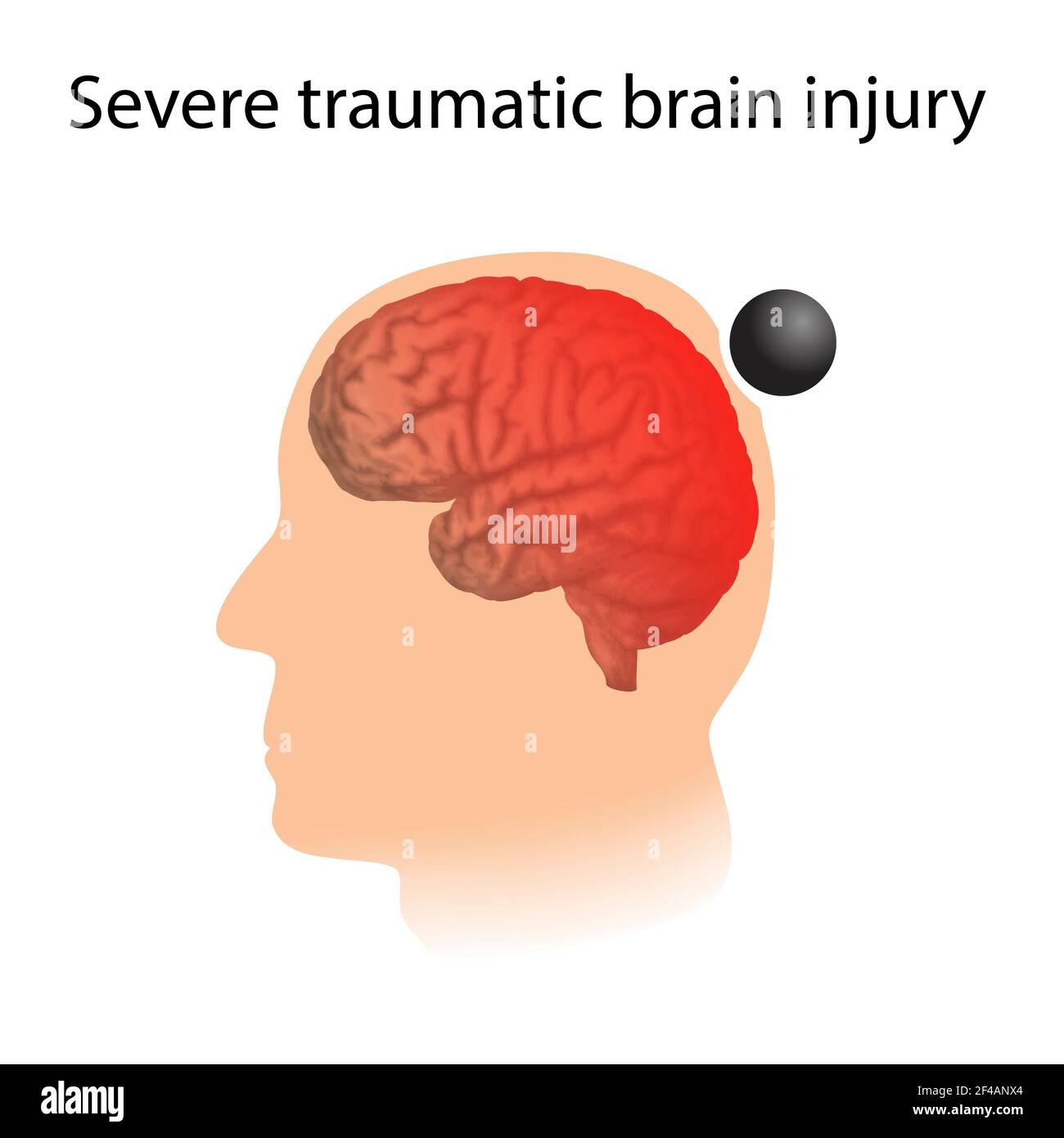 Severe traumatic brain injury, illustration Stock Photo - Alamy