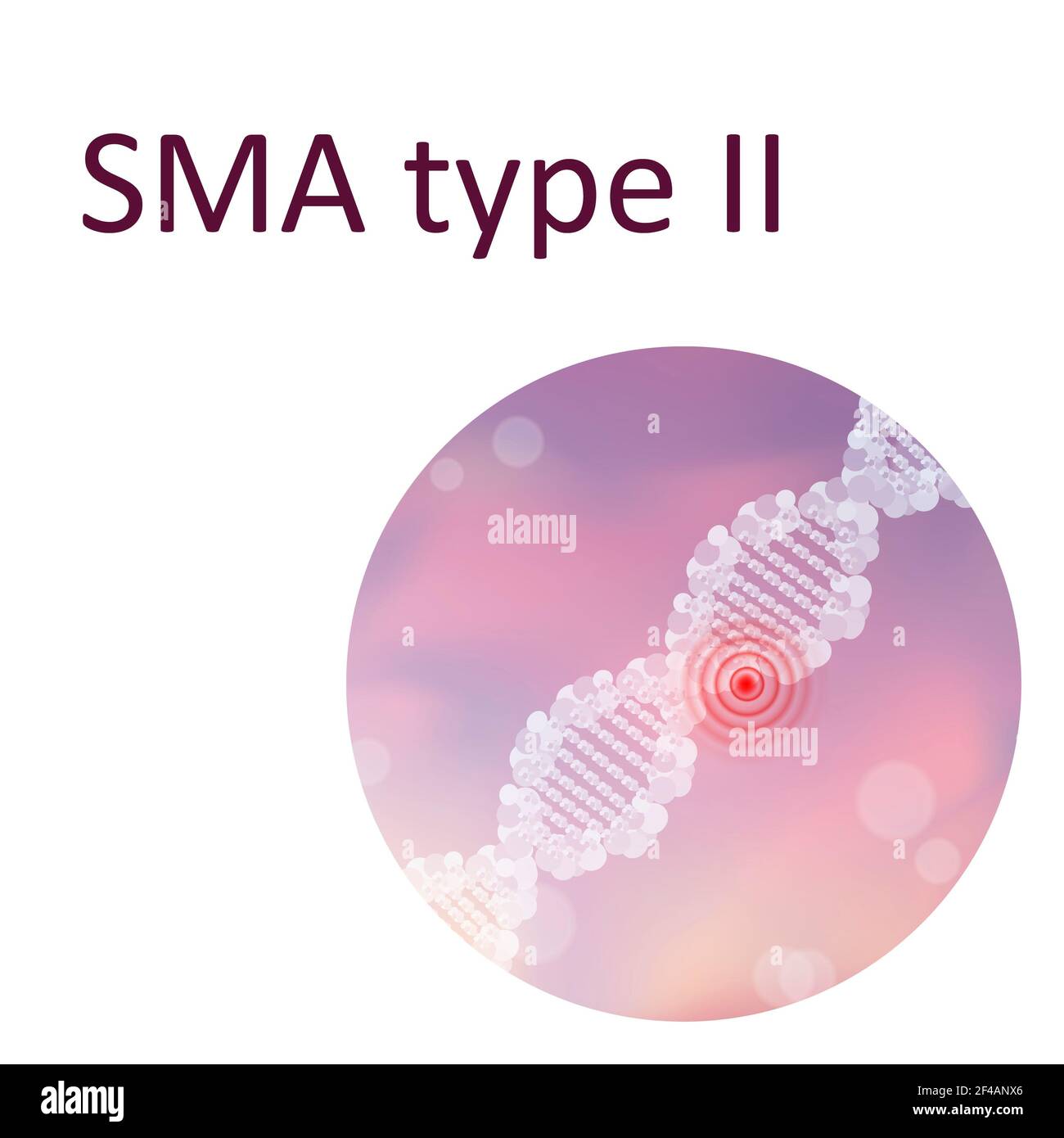 Spinal muscular atrophy type II, illustration Stock Photo - Alamy