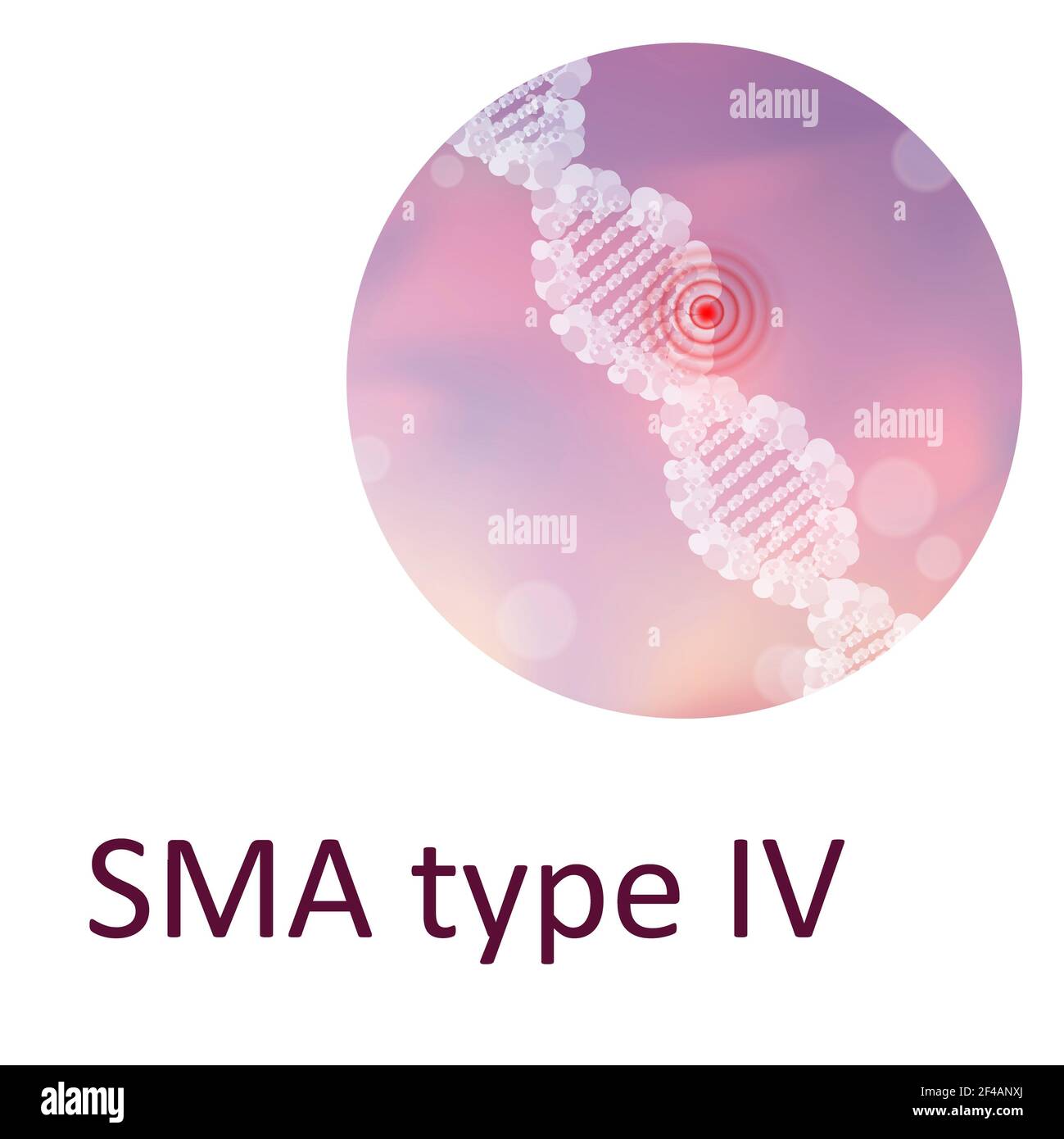 Spinal muscular atrophy type IV, illustration Stock Photo - Alamy