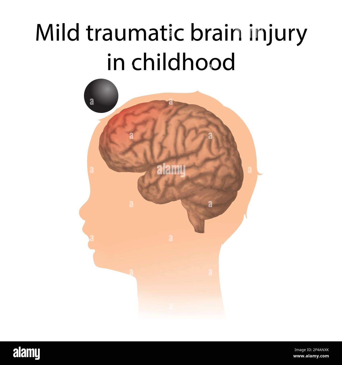 Mild traumatic brain injury in childhood, illustration Stock Photo - Alamy