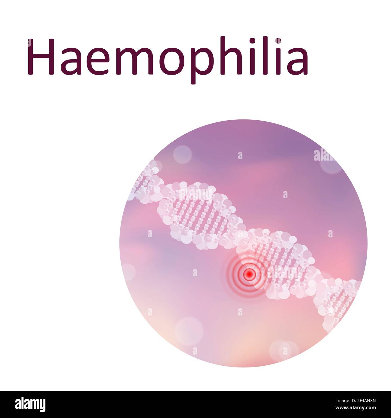Haemophilia hi-res stock photography and images - Alamy