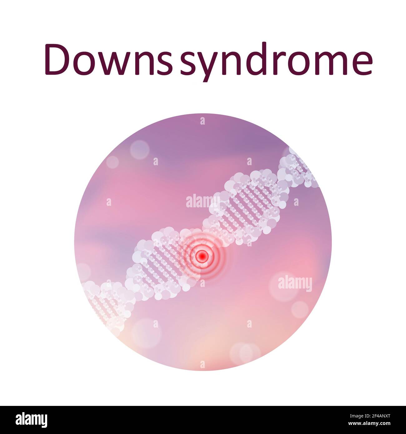Down syndrome, illustration Stock Photo - Alamy