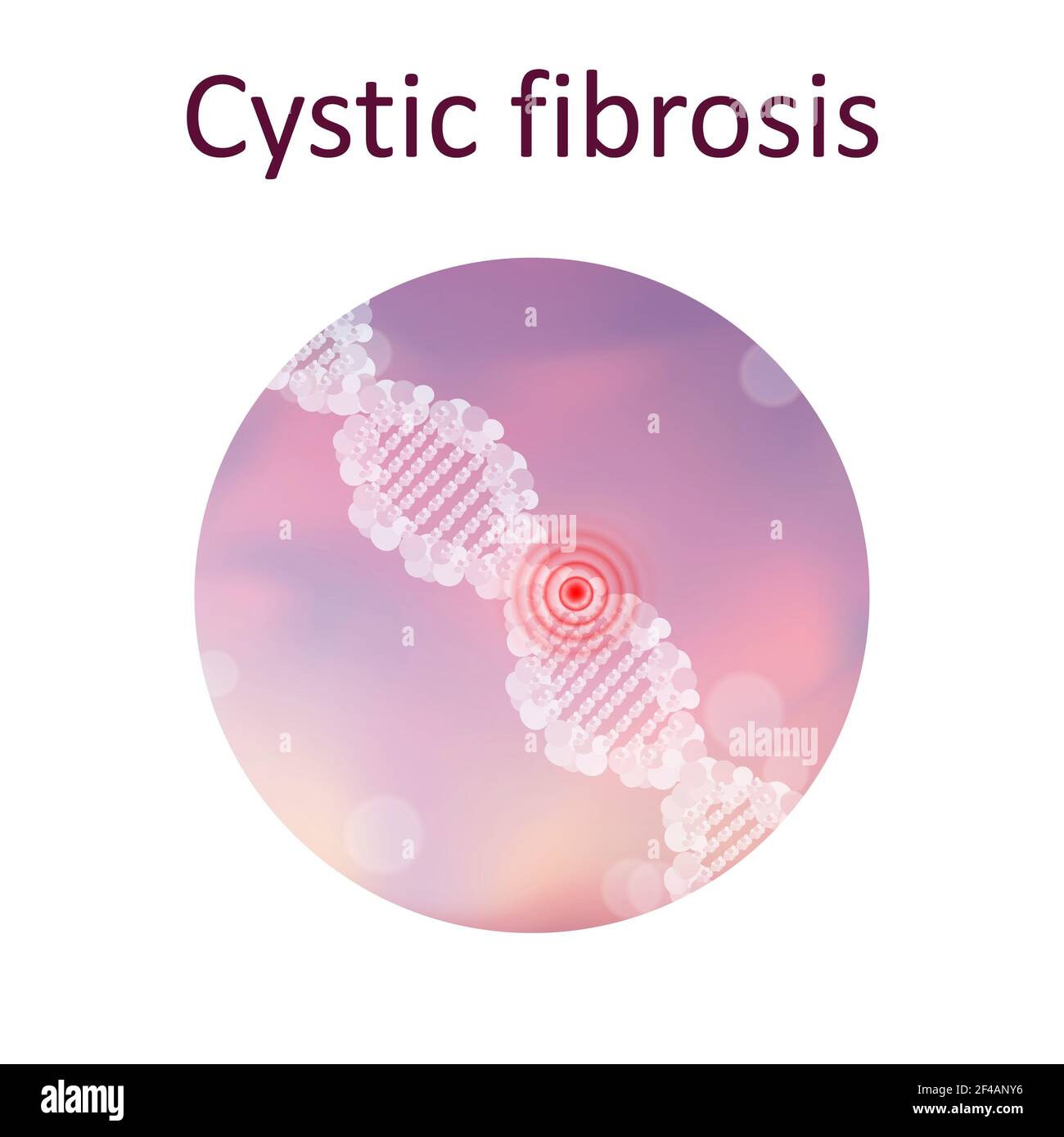 Cystic fibrosis, illustration Stock Photo - Alamy