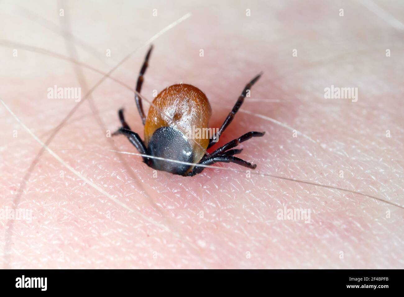 Tick with its chelicerae sticking in human skin Stock Photo - Alamy