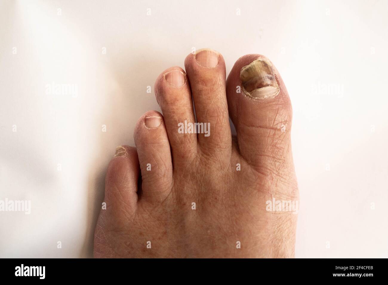 Bruised toe hi-res stock photography and images - Alamy