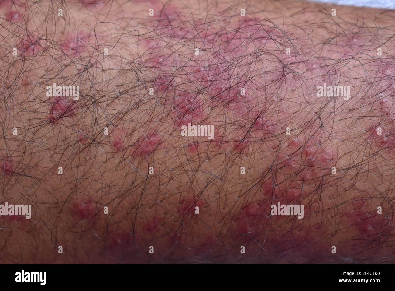 A closeup of post-vaccination rashes on the skin Stock Photo - Alamy