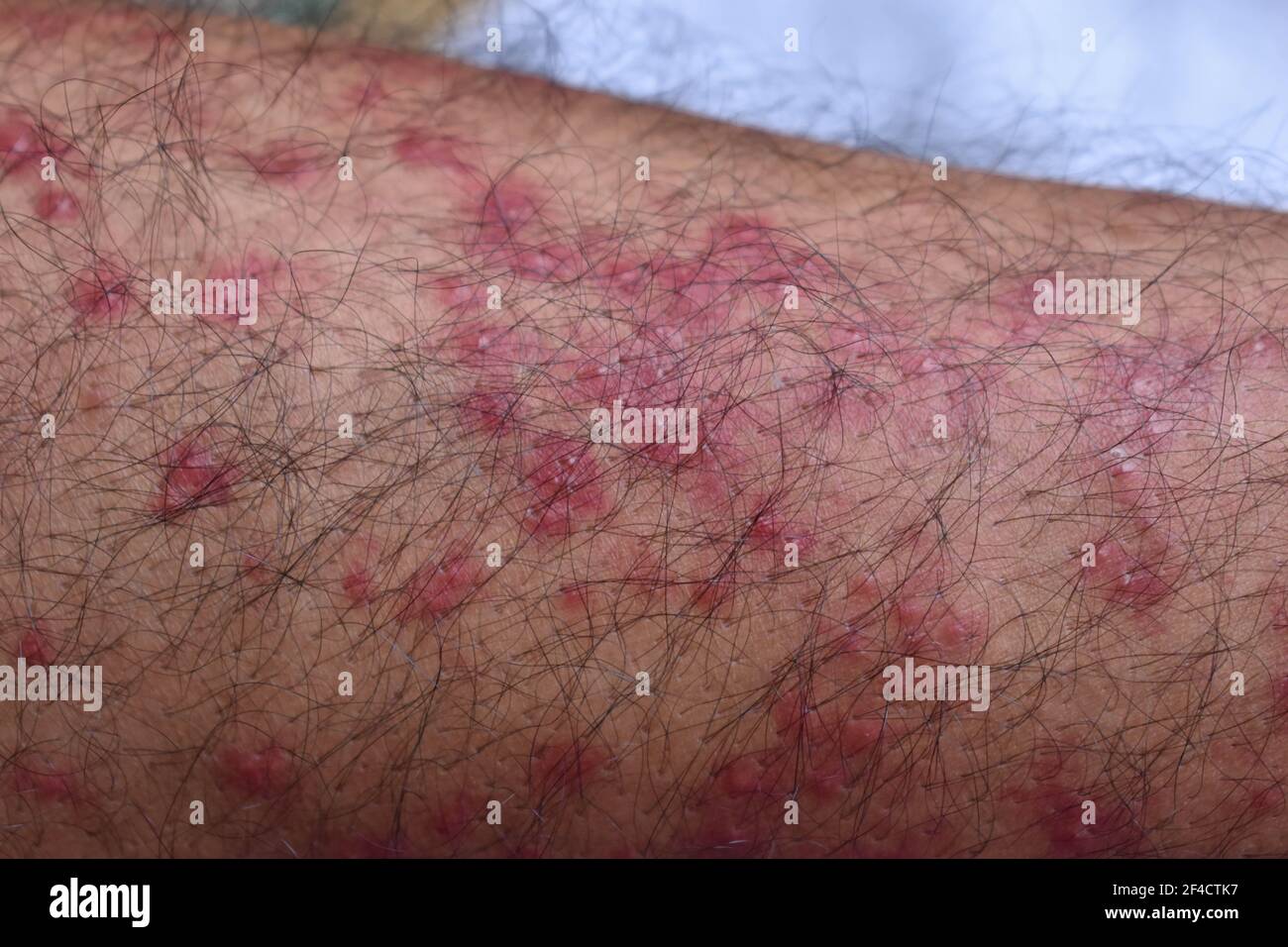 A closeup of post-vaccination rashes on the skin Stock Photo - Alamy