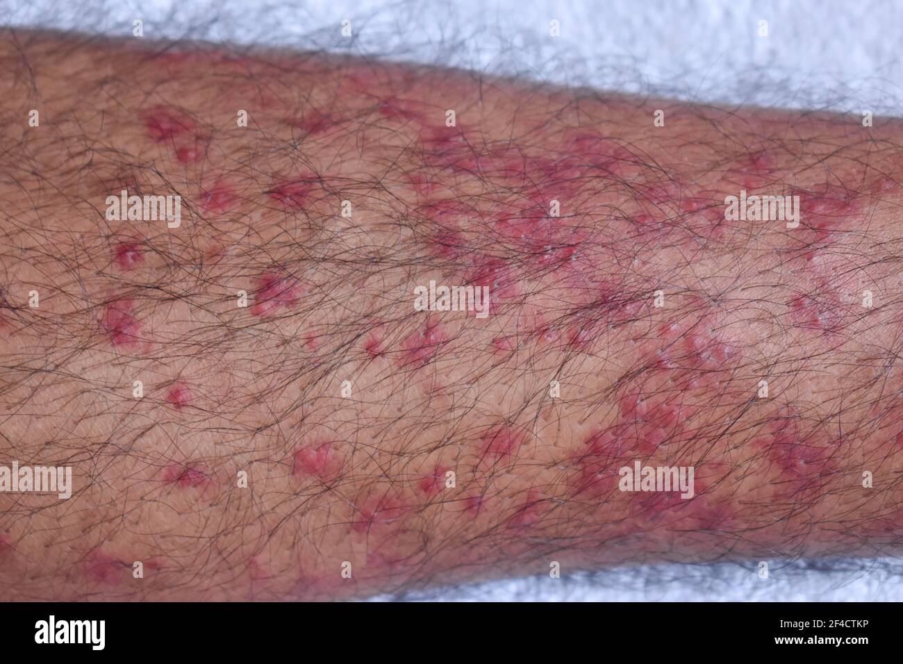 Red rash hives urticaria hi-res stock photography and images - Alamy