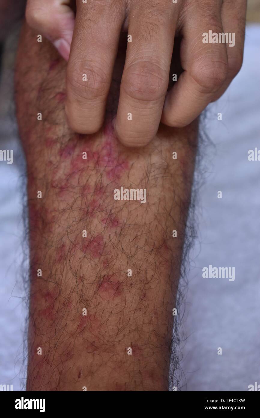 A vertical closeup of post-vaccination rashes on the skin Stock Photo ...