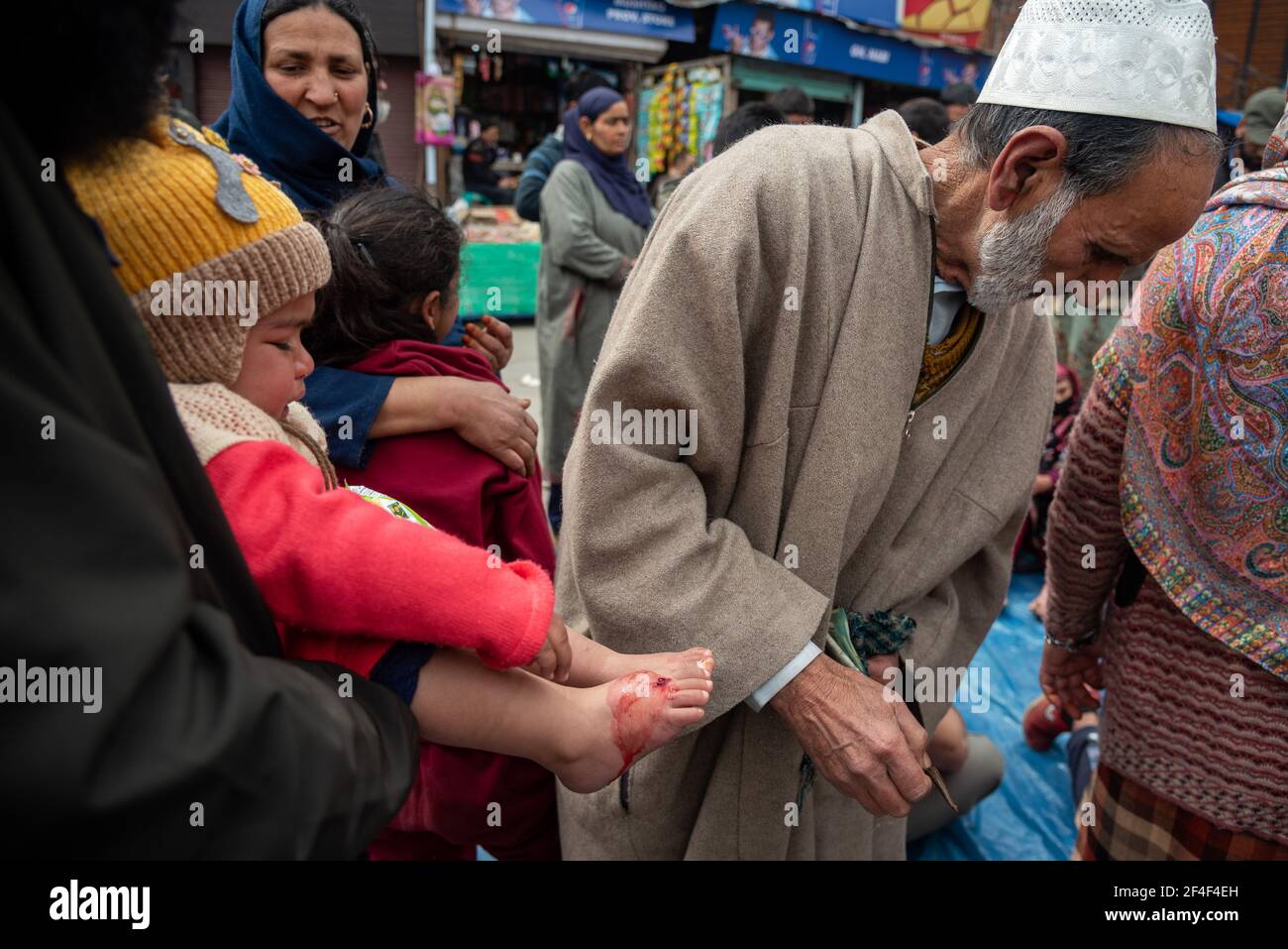 Srinagar, India. 21st Mar, 2021. Blood comes out from the feet of a kid ...