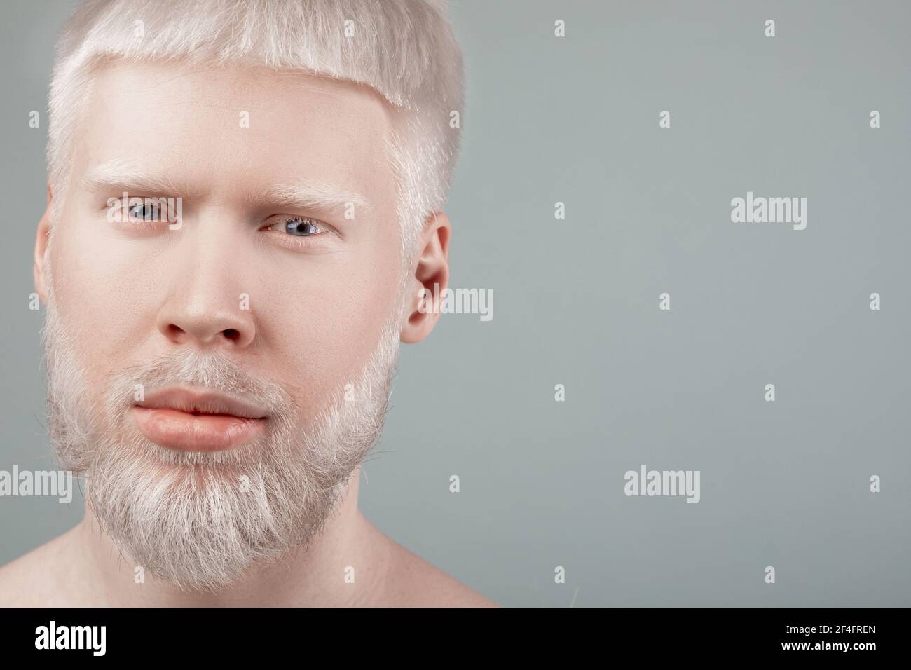 Portrait of albino bearded man with white hair and pale skin looking at ...