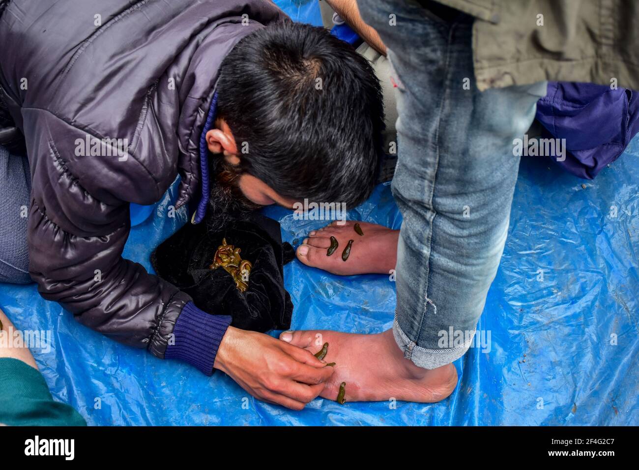 A patient receives leech therapy from a practitioner in Srinagar.Every ...