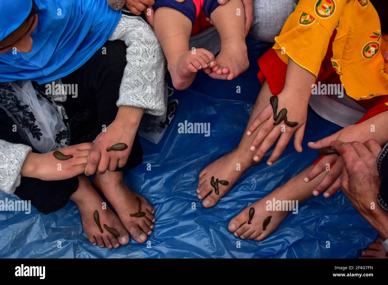 Srinagar, India. 21st Mar, 2021. Kashmiri patients receive leech ...