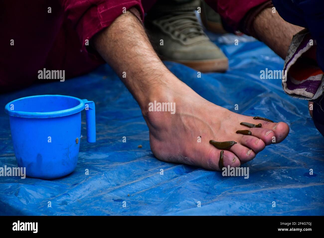 Srinagar, India. 21st Mar, 2021. A patient receives leech therapy in ...