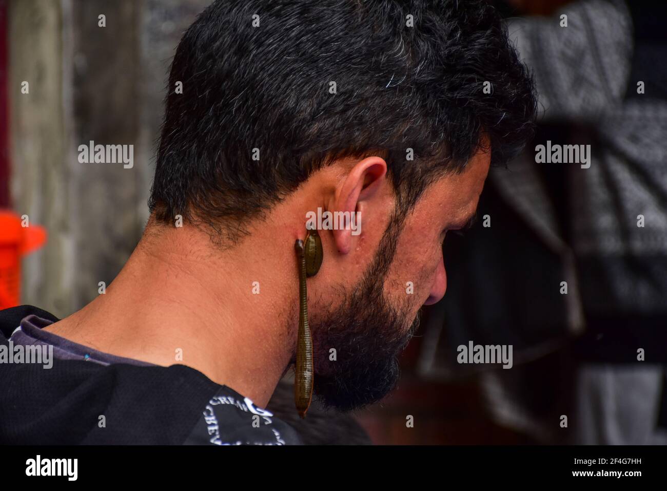 Srinagar, India. 21st Mar, 2021. A patient receives leech therapy on ...