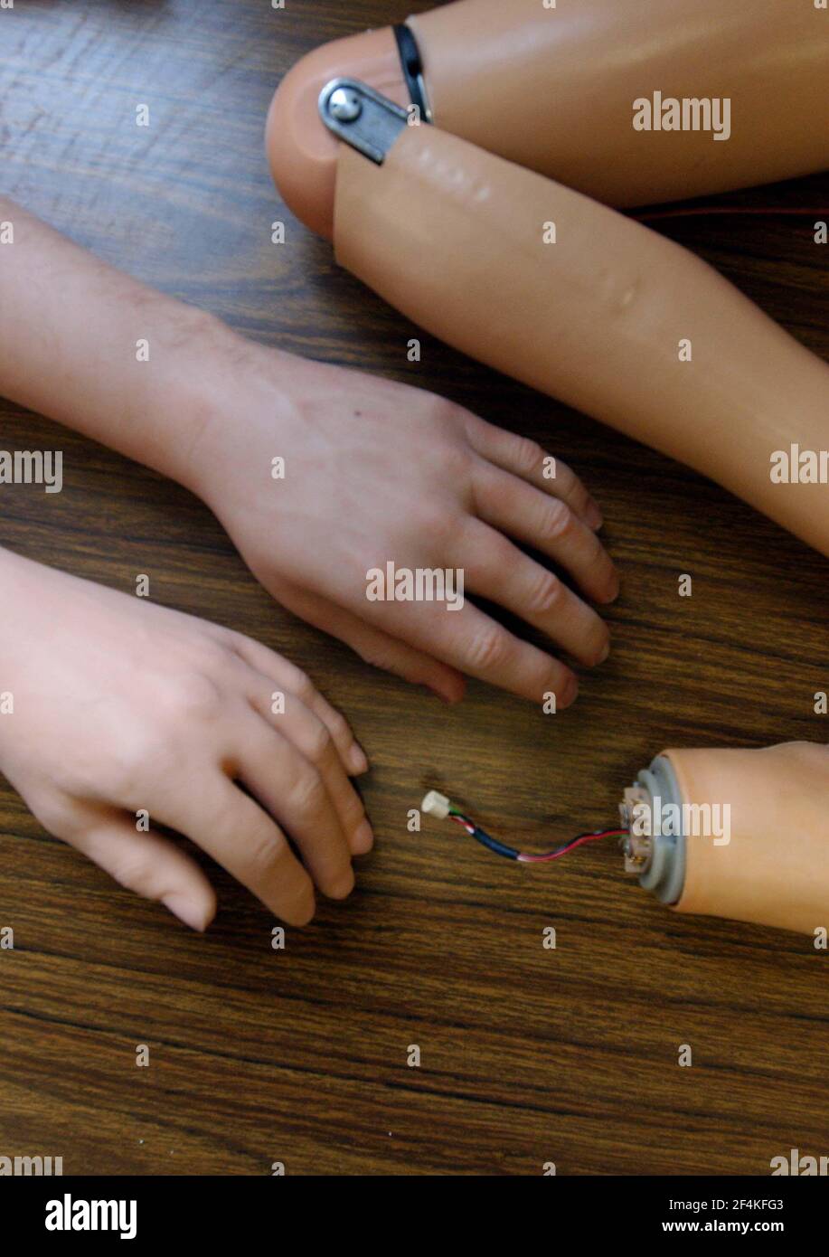 DIFFERENT TYPES OF PROTHESIS AT ST MARYS HOSPITAL,ROEHAMPTON.11/4/03 ...