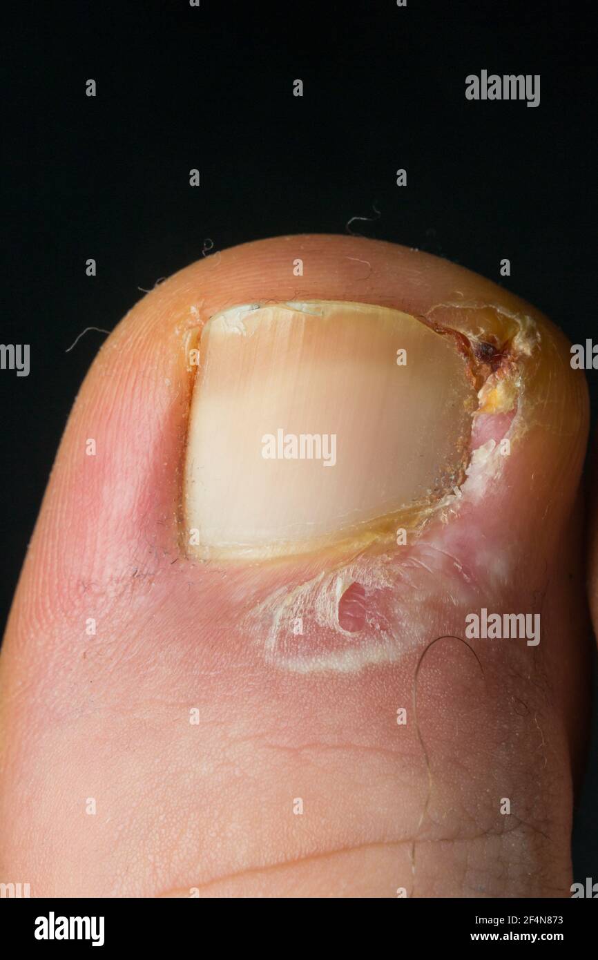 close-up photo of a toenail infection in human Stock Photo - Alamy