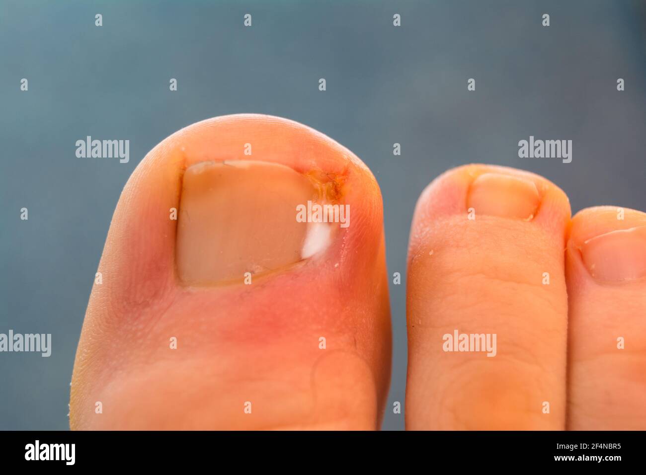 close-up photo of a toenail infection in human Stock Photo - Alamy