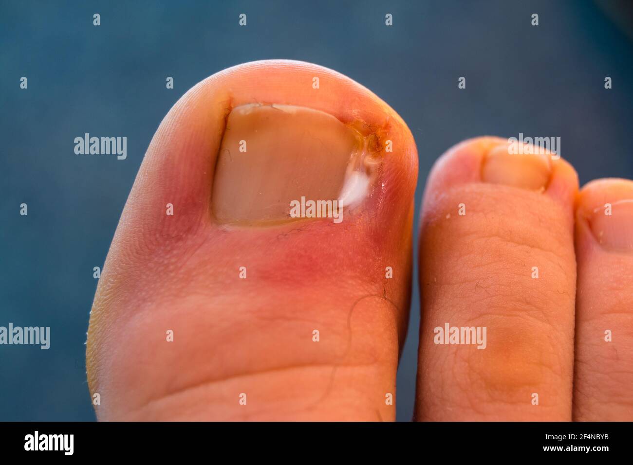 close-up photo of a toenail infection in human Stock Photo - Alamy
