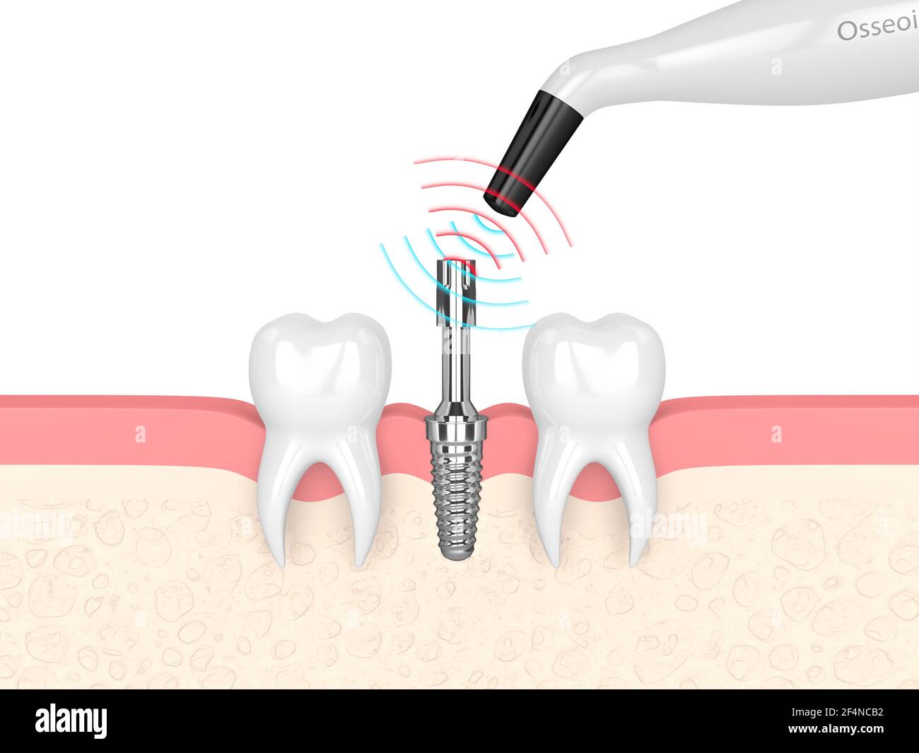 3d render of osseointegration monitoring device checking dental implant ...