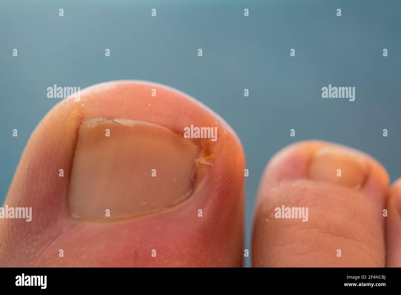 close-up photo of a toenail infection in human Stock Photo - Alamy