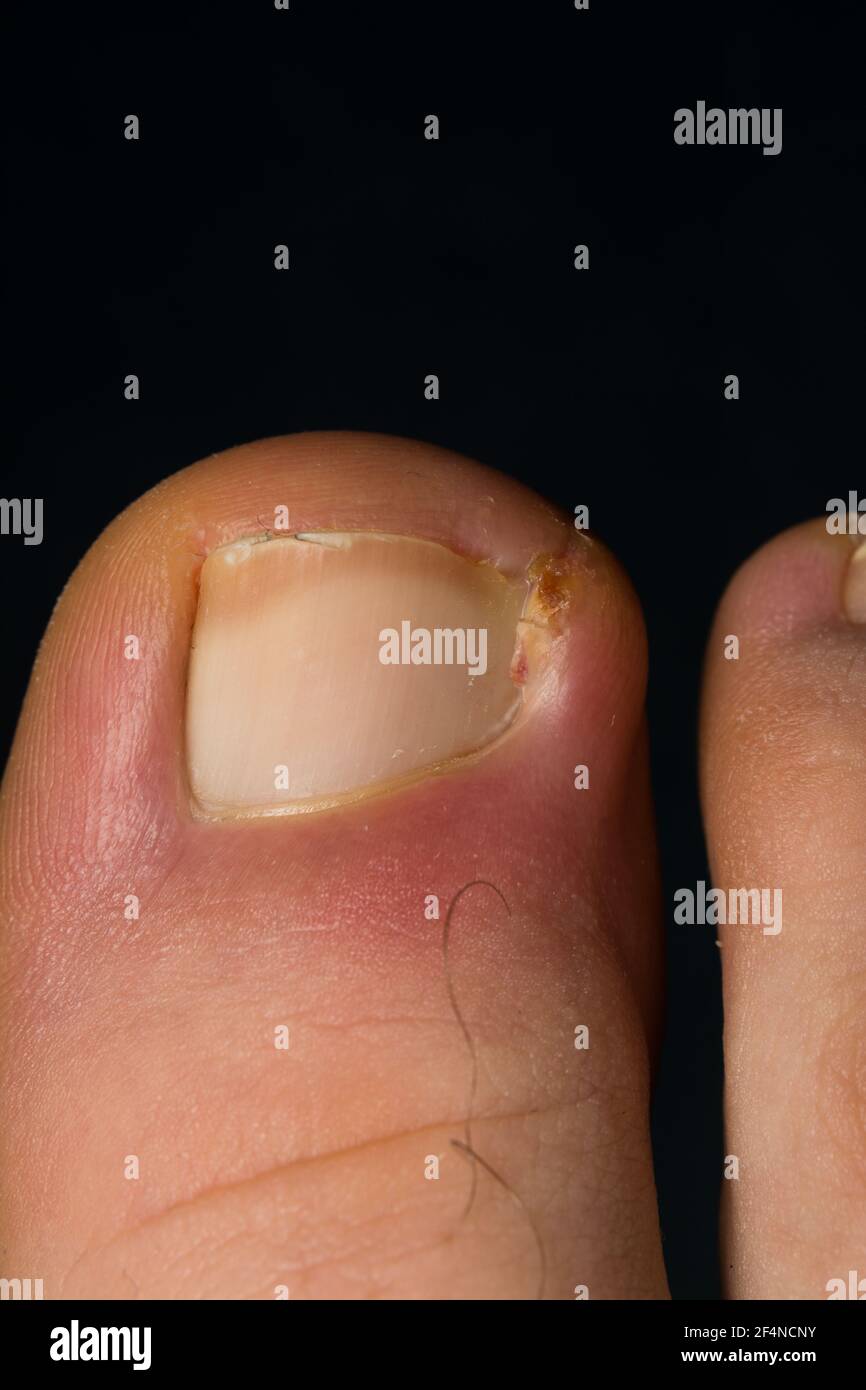 close-up photo of a toenail infection in human Stock Photo - Alamy
