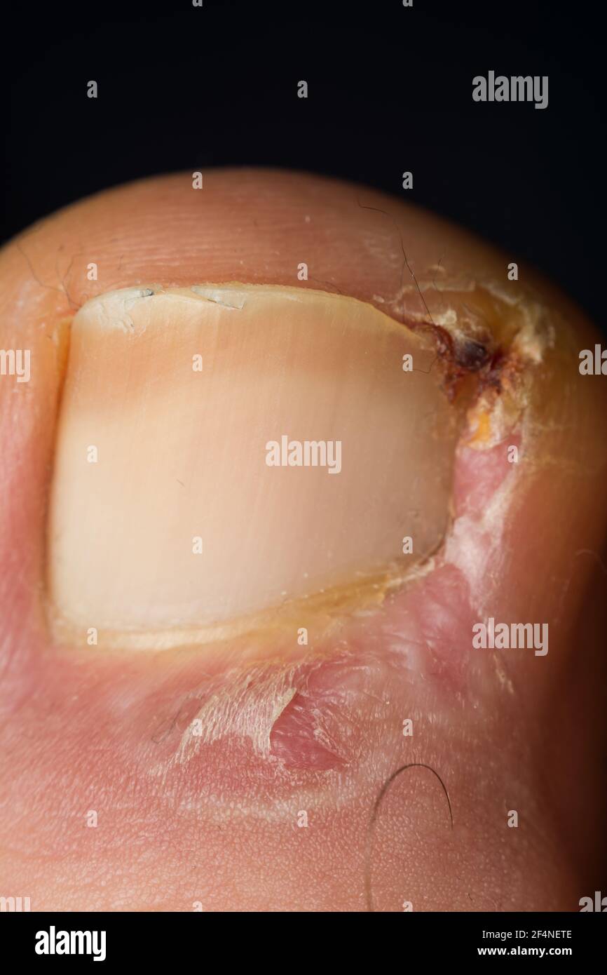 Ugly toenails hi-res stock photography and images - Alamy
