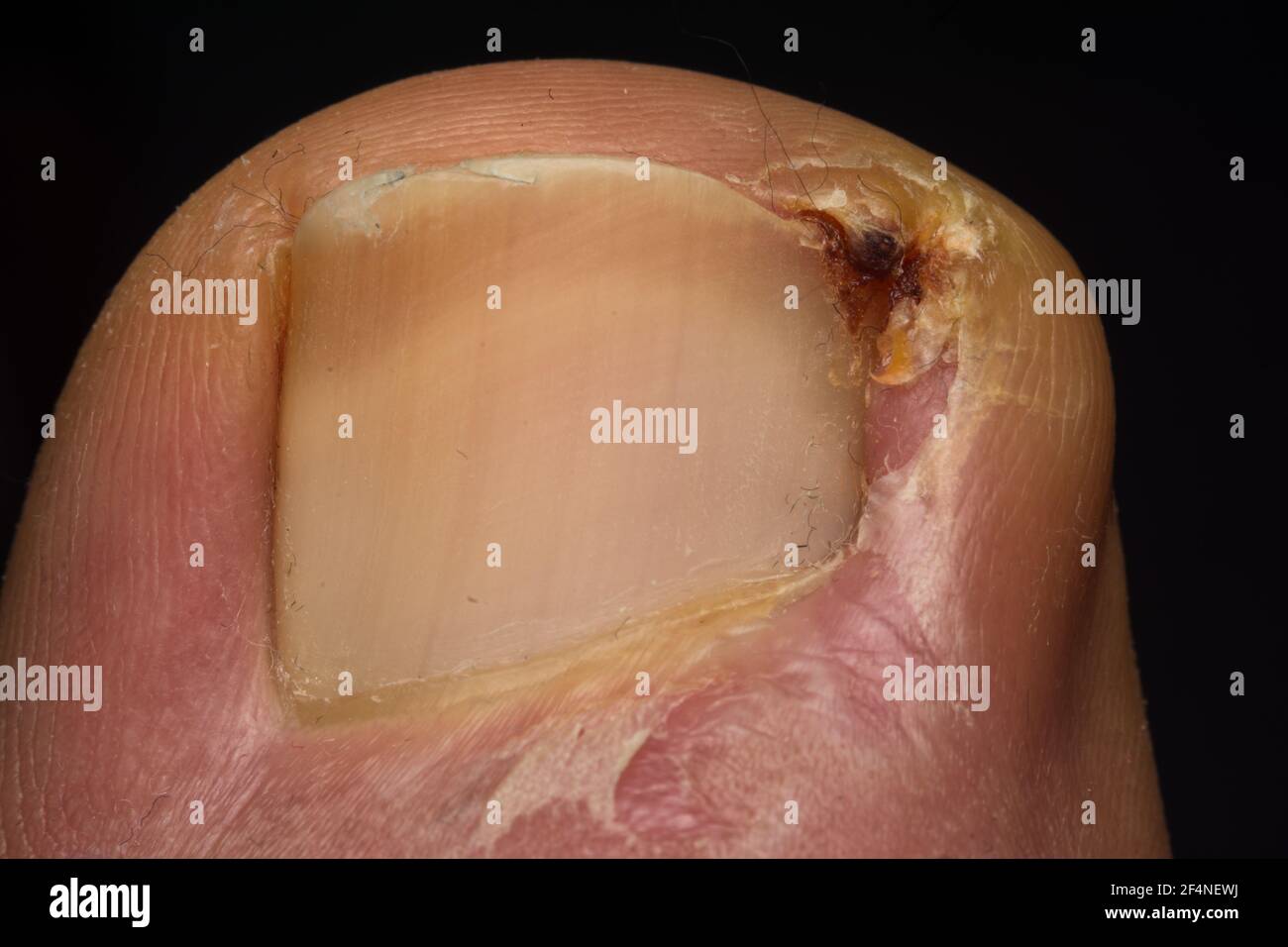 Ingrown toenails hi-res stock photography and images - Alamy