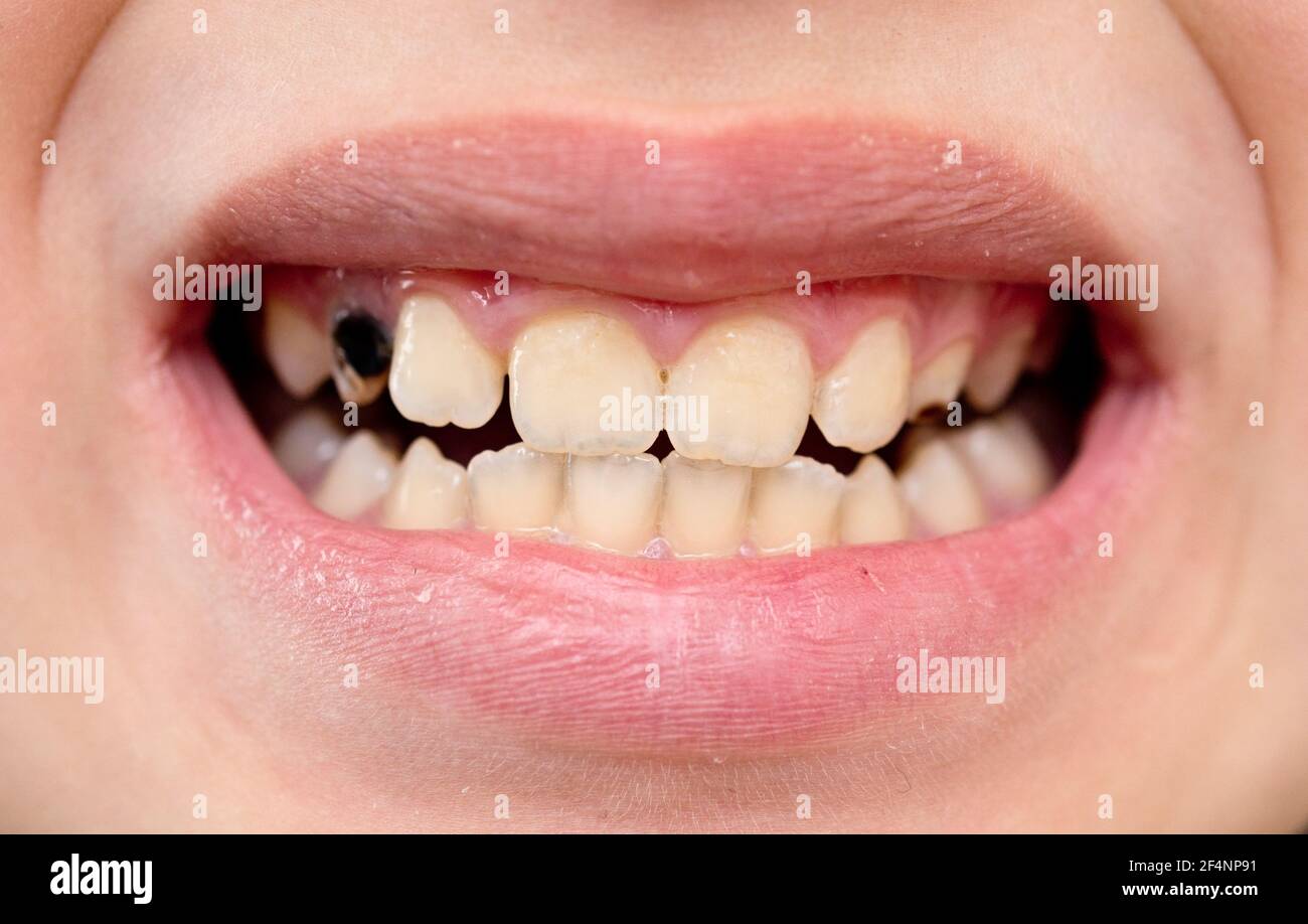 Close up shot of baby teeth Stock Photo - Alamy