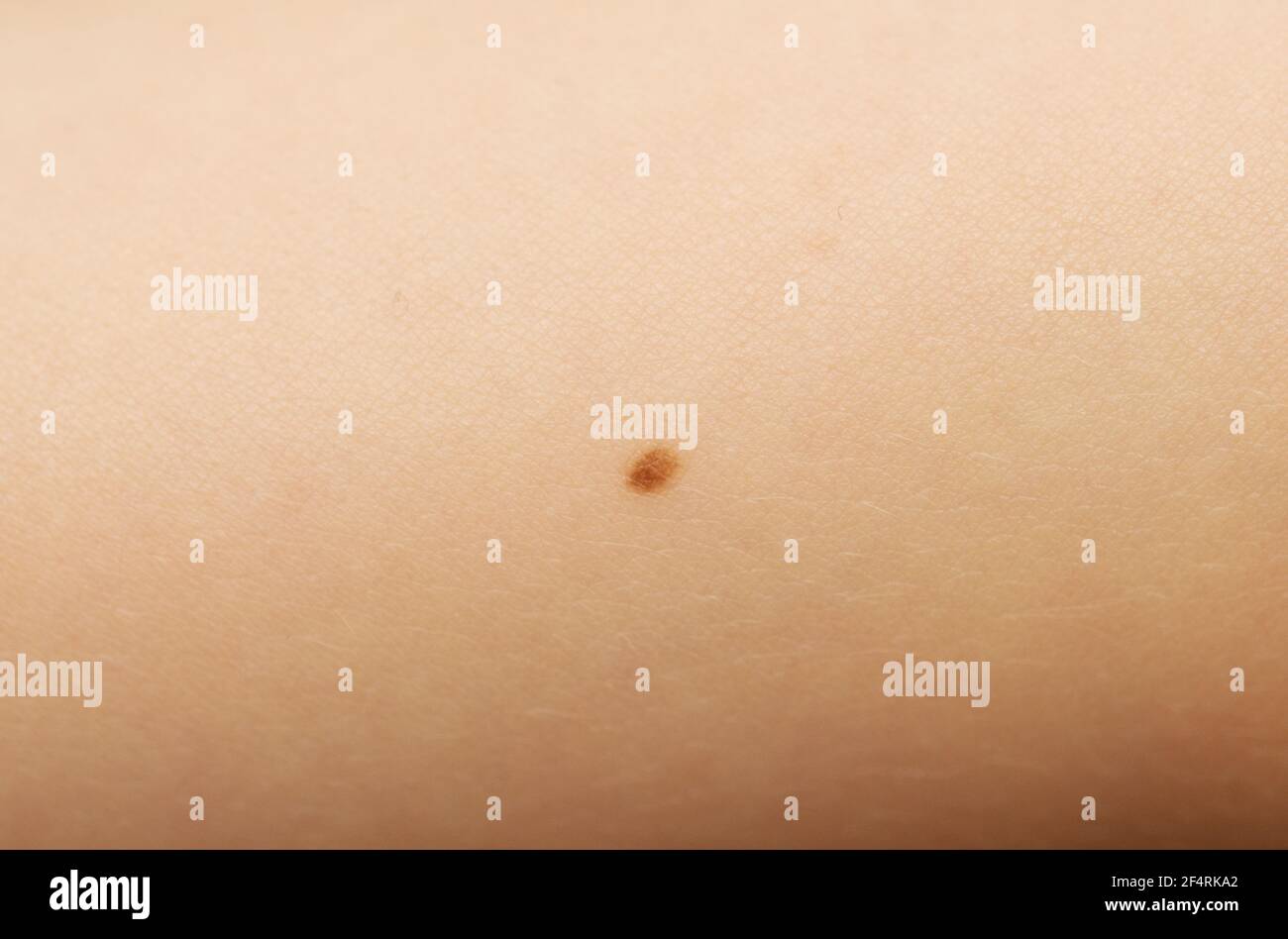 Birthmark on human skin Stock Photo - Alamy