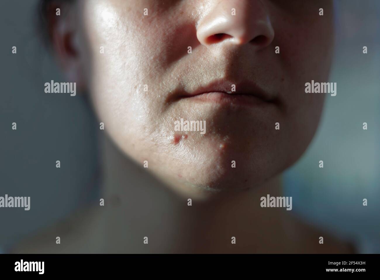 Girl with problematic acne on the face.- closeup Stock Photo - Alamy
