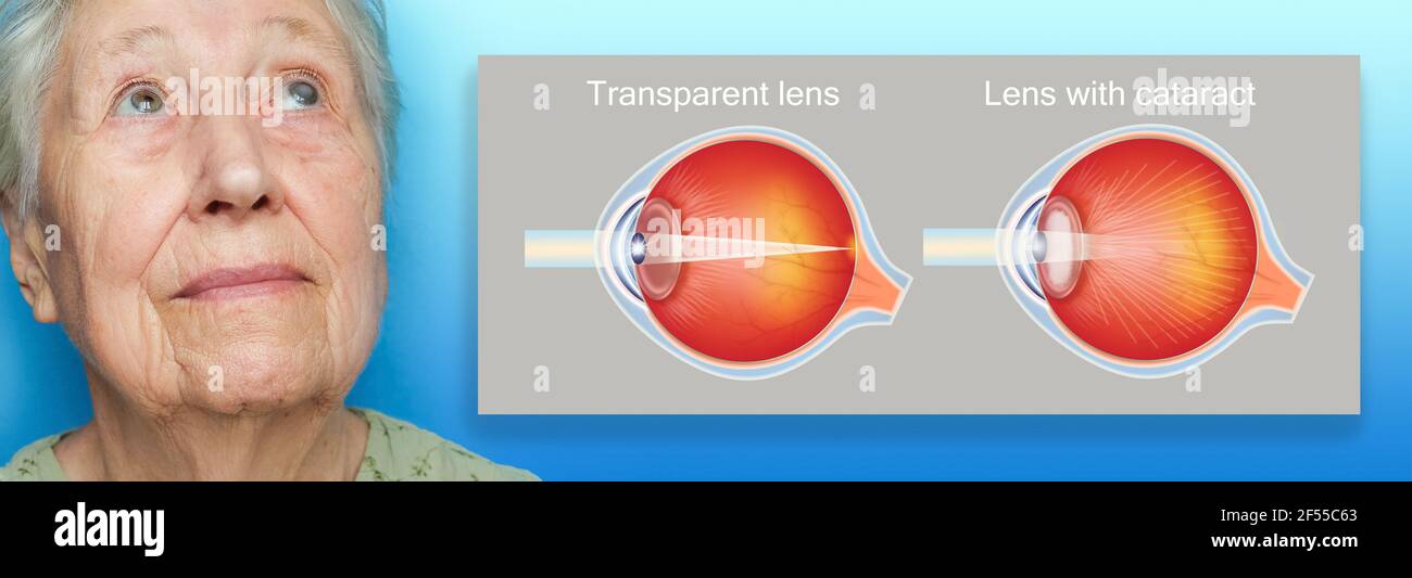 Cataract concept. Senior woman's eye, closeup and cataracts and healthy ...