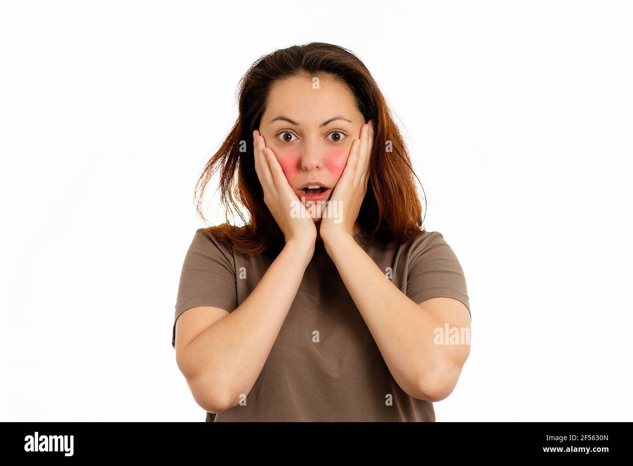 Portrait of a young surprised woman with red inflamed cheeks. White ...