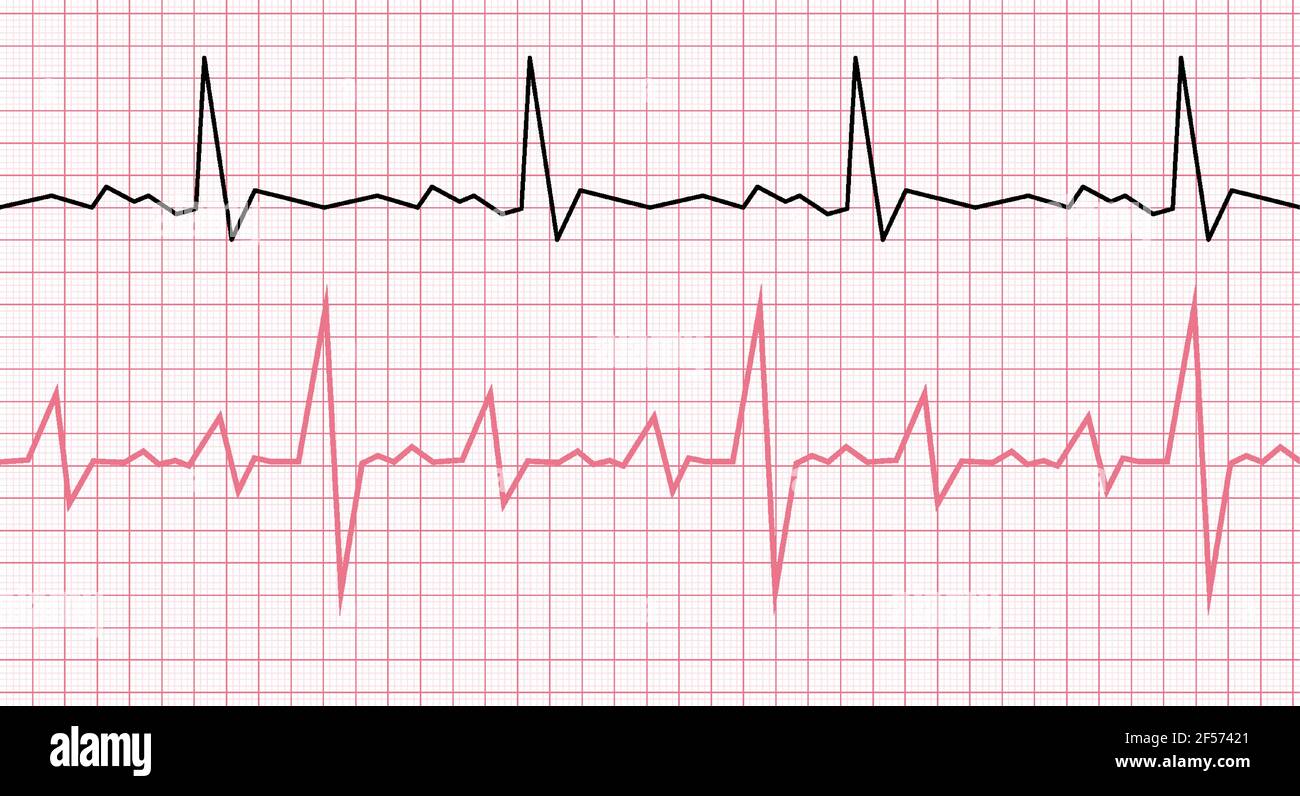 Arrhythmia on an ecg Stock Vector Images - Alamy