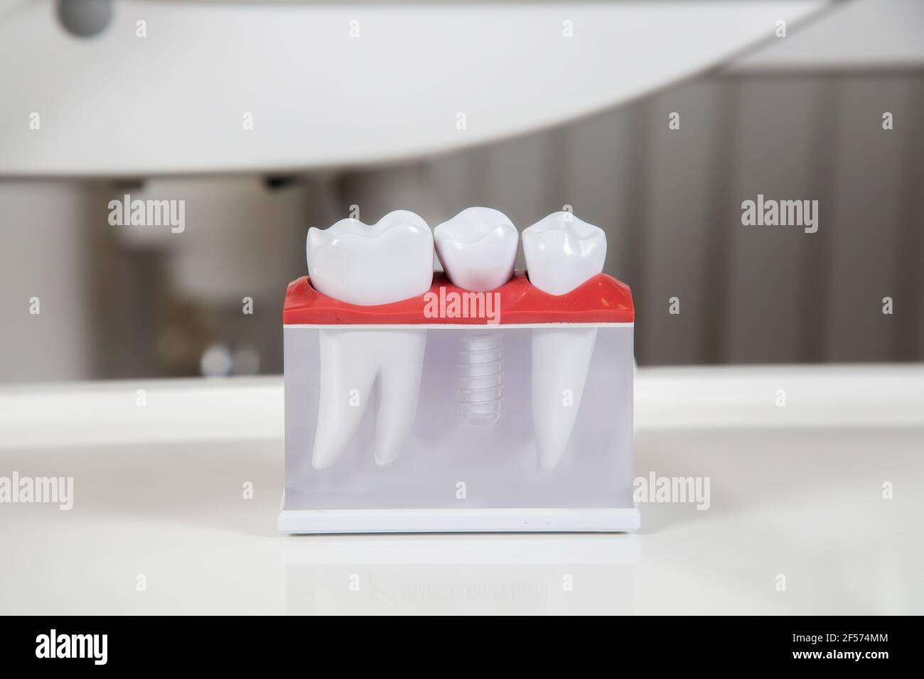 What Is A Pvc Dental Crown at Eve Collie blog